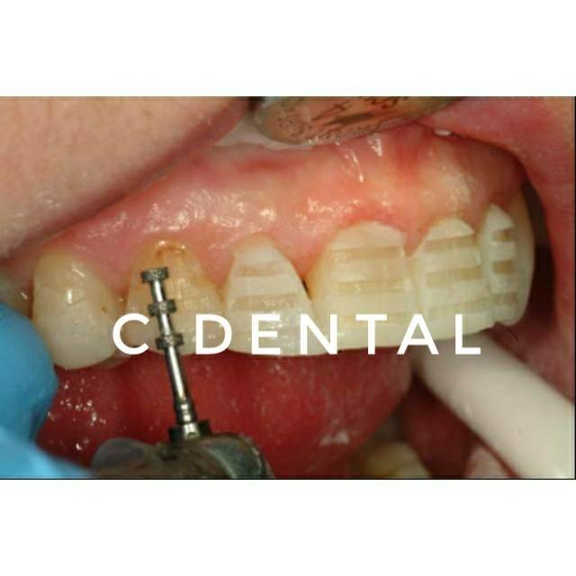 Jual Dental Labial Veneer Prep Marker Diamond Bur Preparasi Gigi ...