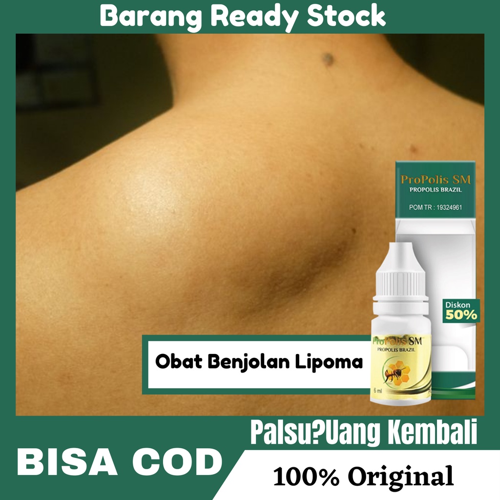 Jual Obat Benjolan Lipoma , Benjolan Di Bokong , Benjolan Di Paha ...
