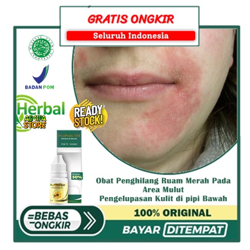 Jual Obat Penghilang Ruam Merah Pada Area Mulut, Pengelupasan Kulit di ...