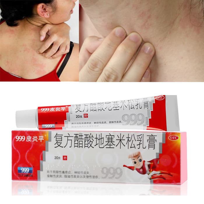 Jual Salep 999 Piyan Ping , Pi Yan Ping ( Salep Gatal, jamur, eksim ) | Shopee Indonesia