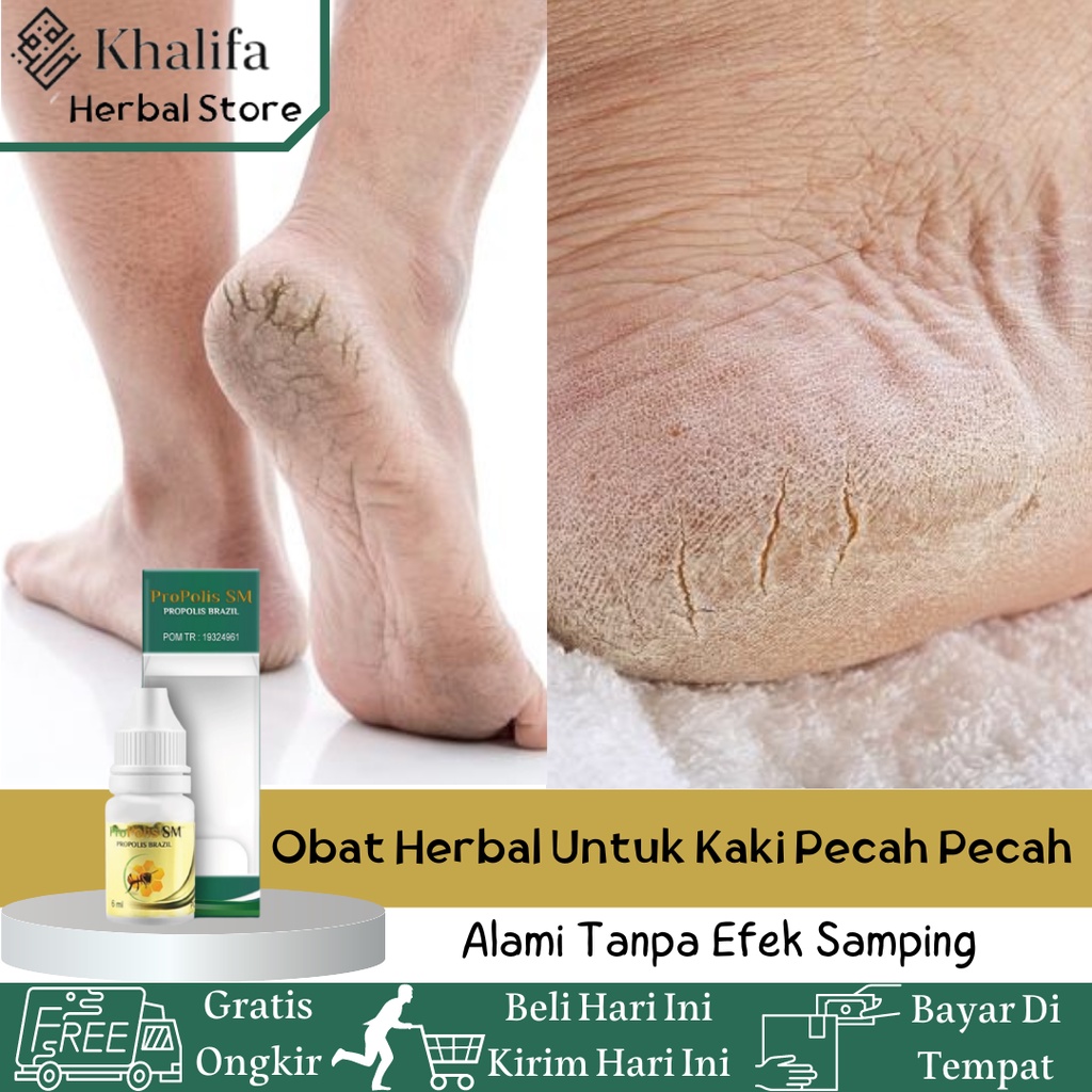 Jual Obat Kaki Pecah Pecah, Obat Tumit Pecah Pecah Dan Kering, Obat ...