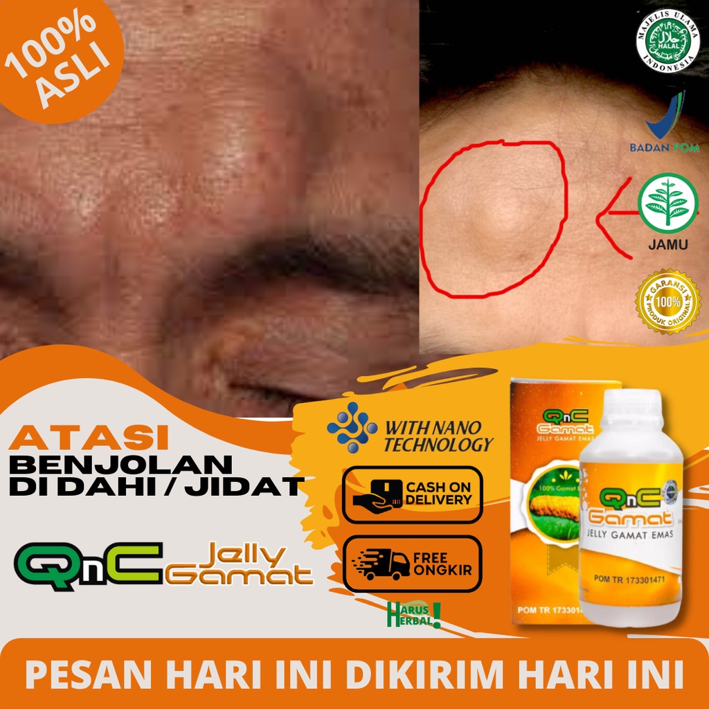 Jual Obat Pengempis Benjolan Di Dahi/Di Jidat, Penghilang Benjolan ...