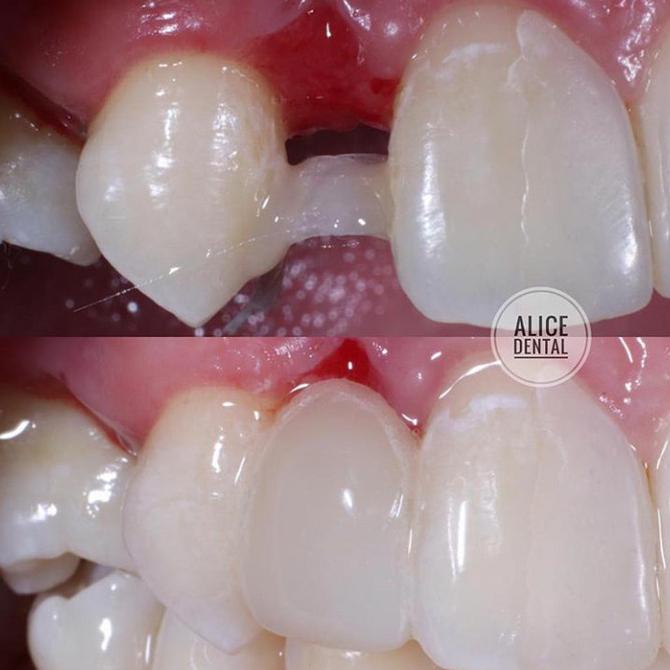 Jual fiber splinting RTD / quartz splint woven (ecer) | Shopee Indonesia