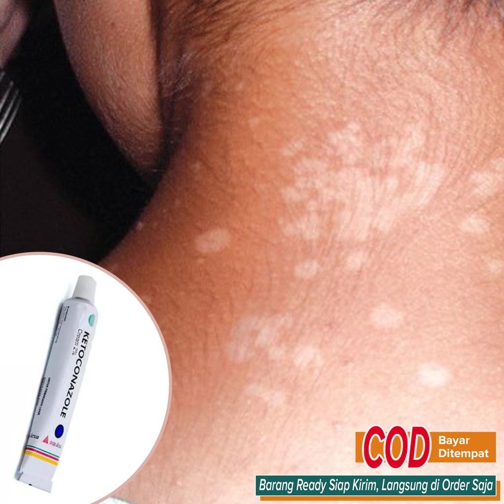 Jual Salep Obat Panu Pembersih Panu BANDEL Murah AMPUH membersihkan ...