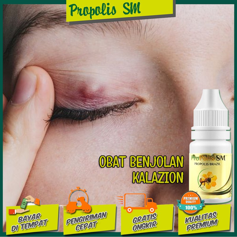 Jual Obat Benjolan Kalazion Atau Benjolan di Mata Propolis SM Brazil ...