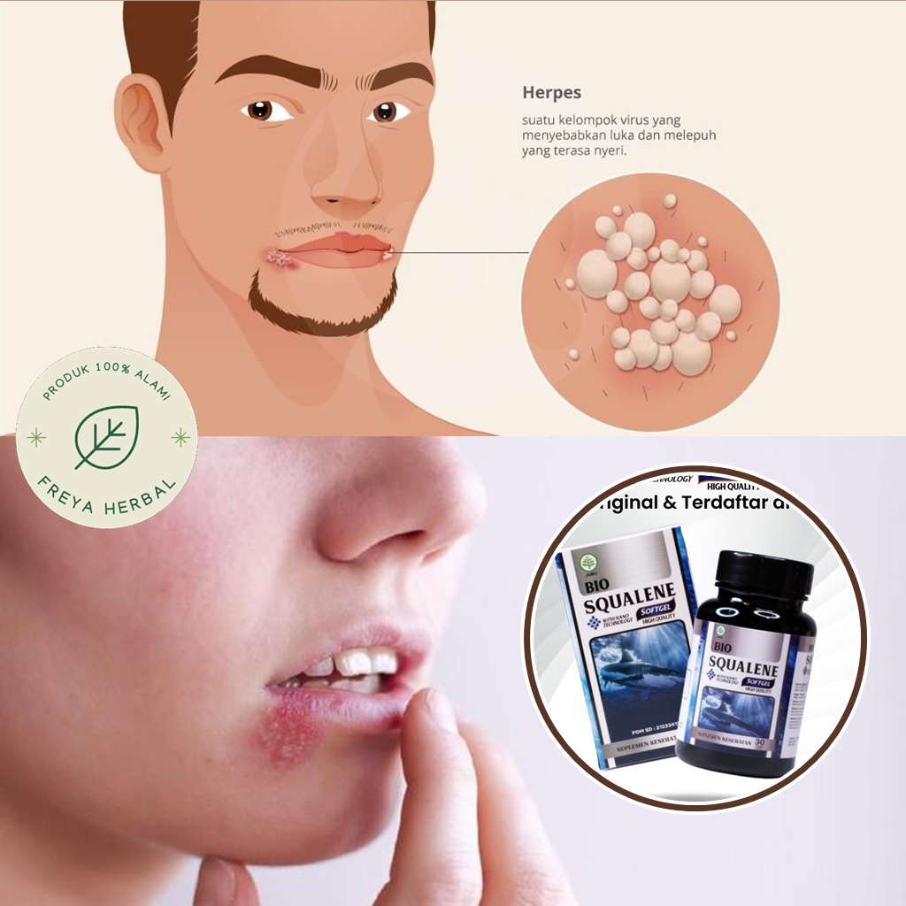 Jual OBAT HERPES, OBAT HERBAL SIMPLEX, OBAT HERPES ZOSTER, OBAT HERPES ...