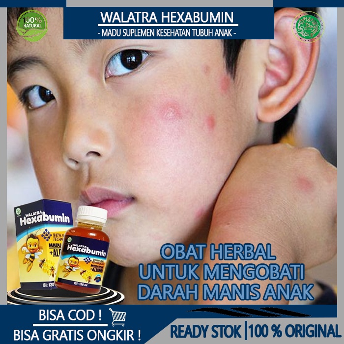 Jual Obat Darah Manis Pada Anak, Madu Untuk Atasi Amis Daging, Obat ...