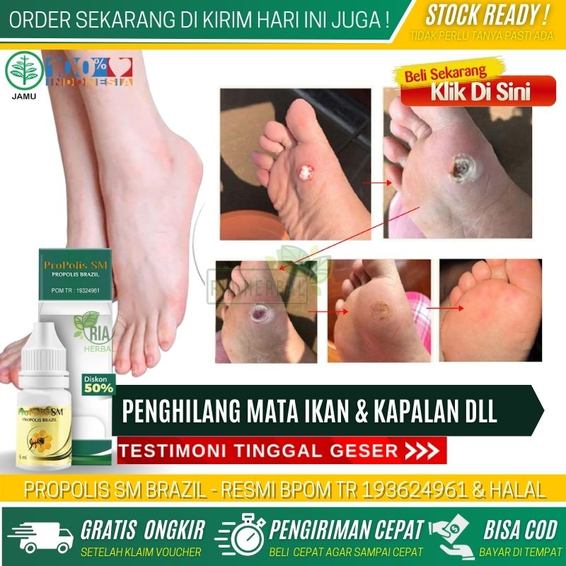 Jual Obat Perontok Mata Ikan di Telapak Kaki / Tangan, Obat Clavus di ...