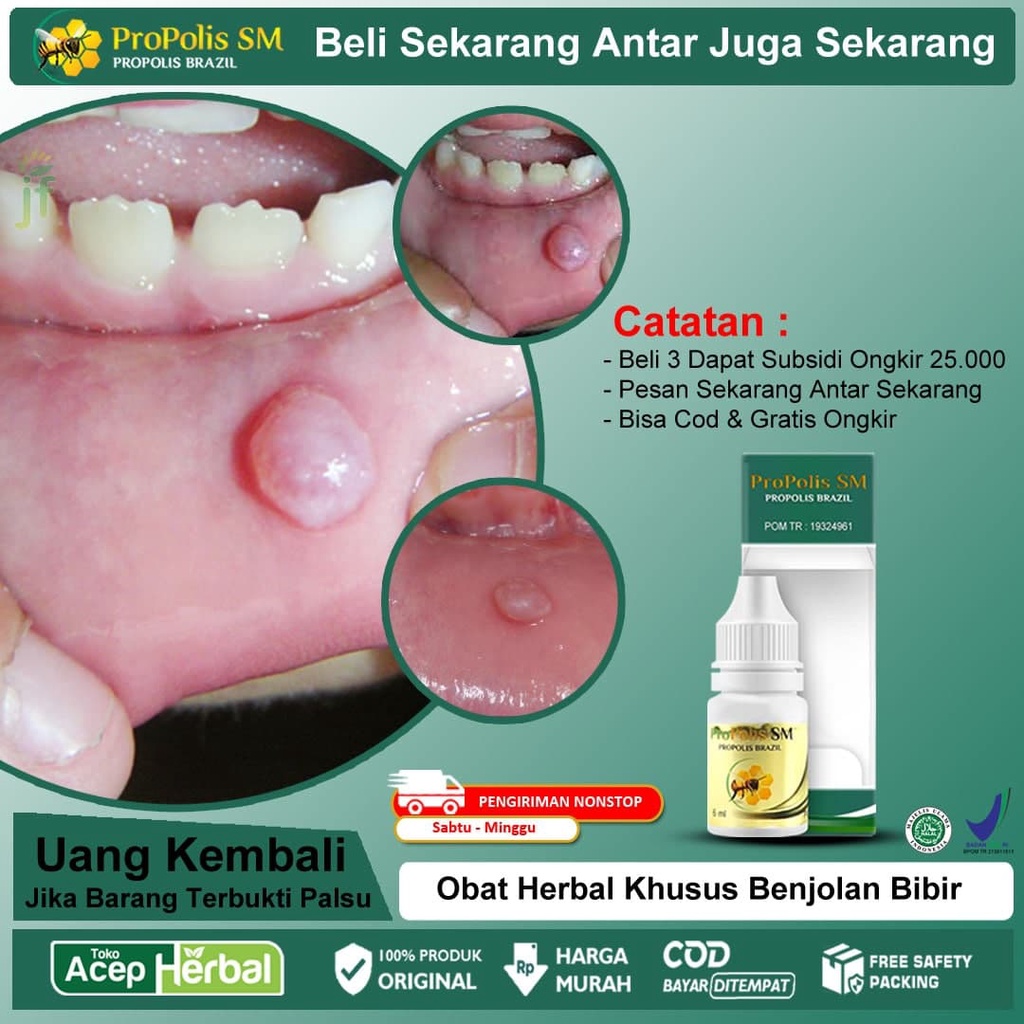 Jual Obat Benjolan Di Bibir Mulut, Sakit dan Nyeri, Gusi Bengkak ...