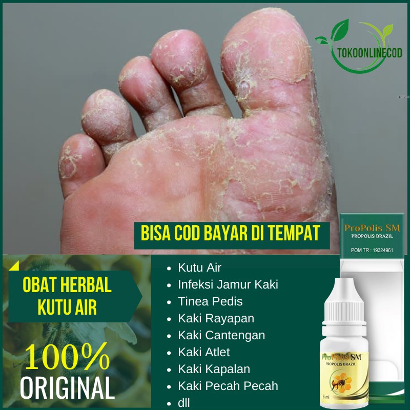 Jual Obat Kutu Air - Kutu Air Kaki - Kutu Air Tangan - Tinea Pedis ...