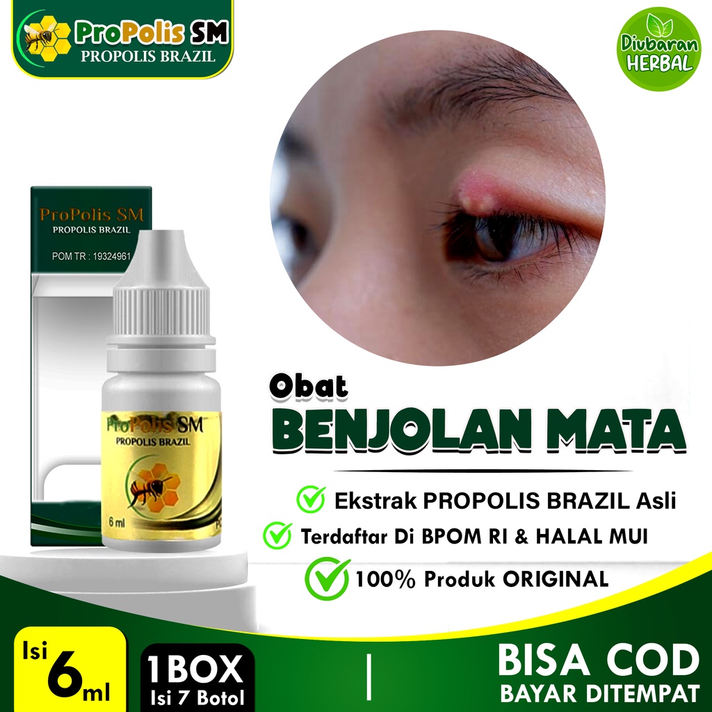 Jual Obat Benjolan Mata Kalazion Bintitan Propolis Sm Original | Shopee ...