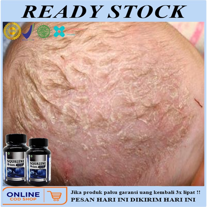 Jual Obat Dermatitis Seboroik, Obat borok di kepala, obat dermatitis seboroik bayi, Obat ...