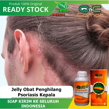 Jual Jelly Obat Penghilang Psoriasis Kepala, Gatel Kulit Kepala, Kulit Kepala Berkerak, Ketombe ...