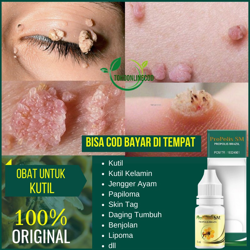 Jual Obat Kutil Alami - Kutil Kelamin - Kutil di Wajah - Kutil di Leher ...