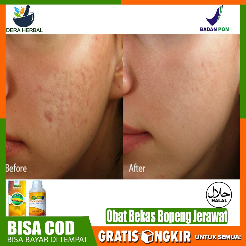 Jual Obat Herbal Asli untuk hilangkan bopeng bekas jerawat obat jerawat Qnc Jelly Gamat Original ...