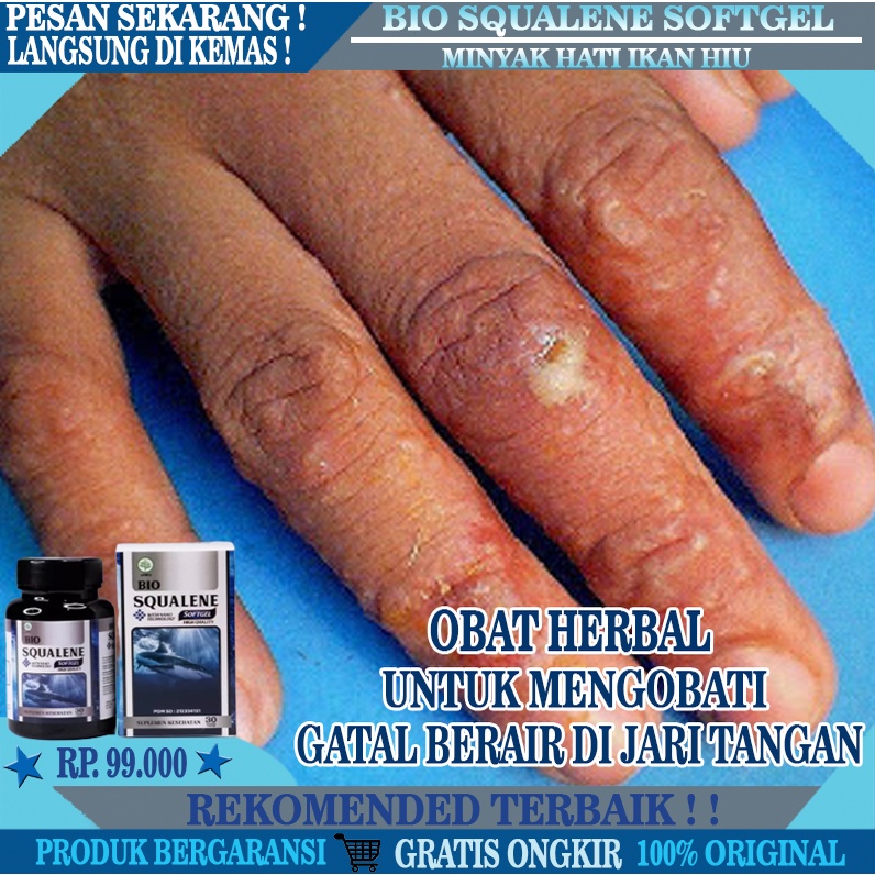 Jual Obat Gatal Berair di Jari Tangan dan Kaki, Obat Bintik Bening ...