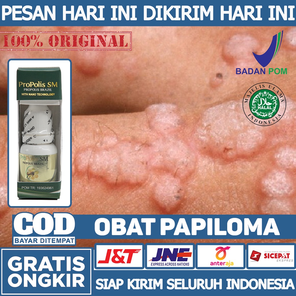 Jual Obat Papiloma - Penghilang Papiloma - Papiloma di Kelopak Mata ...