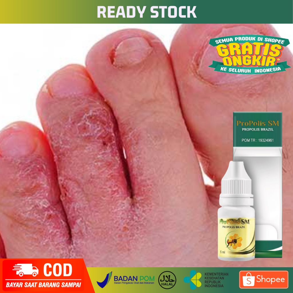 Jual Obat Gatal di Sela Jari Kaki dan Tangan, Obat Kutu Air Kurap Kudis ...