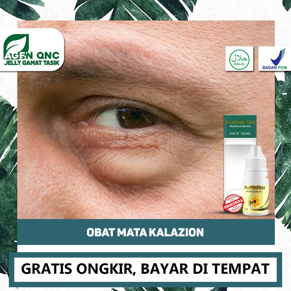 Jual Obat Kalazion Pada Kelopak Mata, Mata Bintitan, Benjolan Pada ...