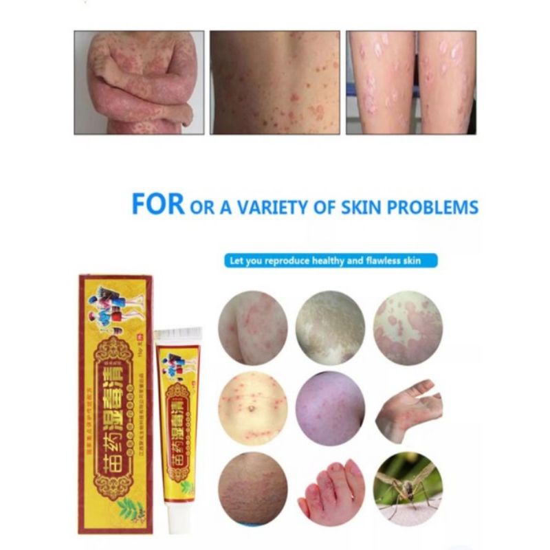 Jual salep obat gatal gatel jamur eksim anti bakteri psoriasis ...