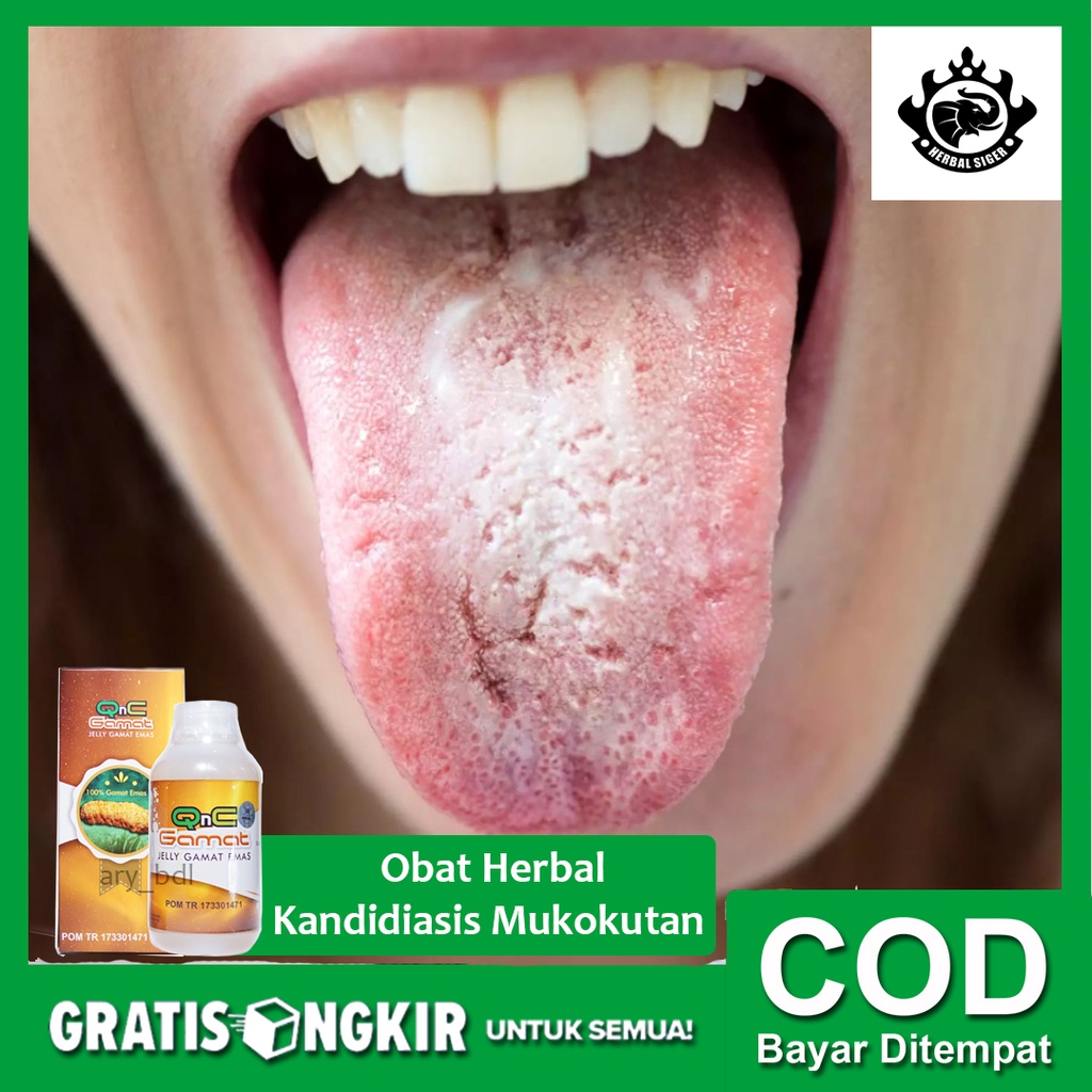 Jual Obat Herbal Kandidiasis Mukokutan, Infeksi Jamur Candida ...