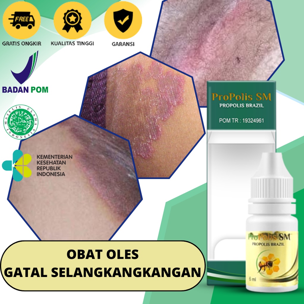 Jual Obat Gatal Selangkangan, pemutih selangkangan Hitam, Kurap Di ...