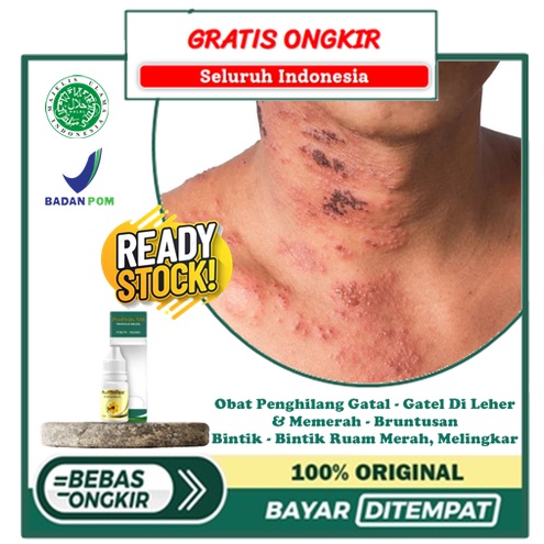 Jual Obat Penghilang Gatal - Gatel Di Leher & Memerah - Bruntusan ...