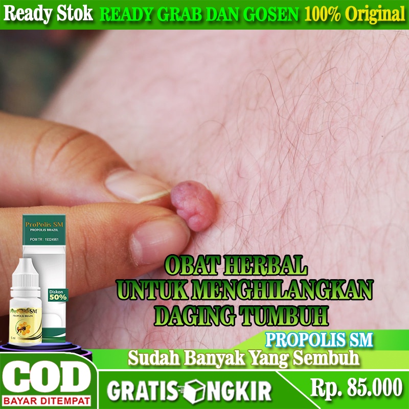 Jual Obat Daging Tumbuh, Obat Daging Tumbuh Di Kulit, Obat Daging Jadi ... Jual Obat Daging Tumbuh, Obat Daging Tumbuh Di Kulit, Obat Daging Jadi ...