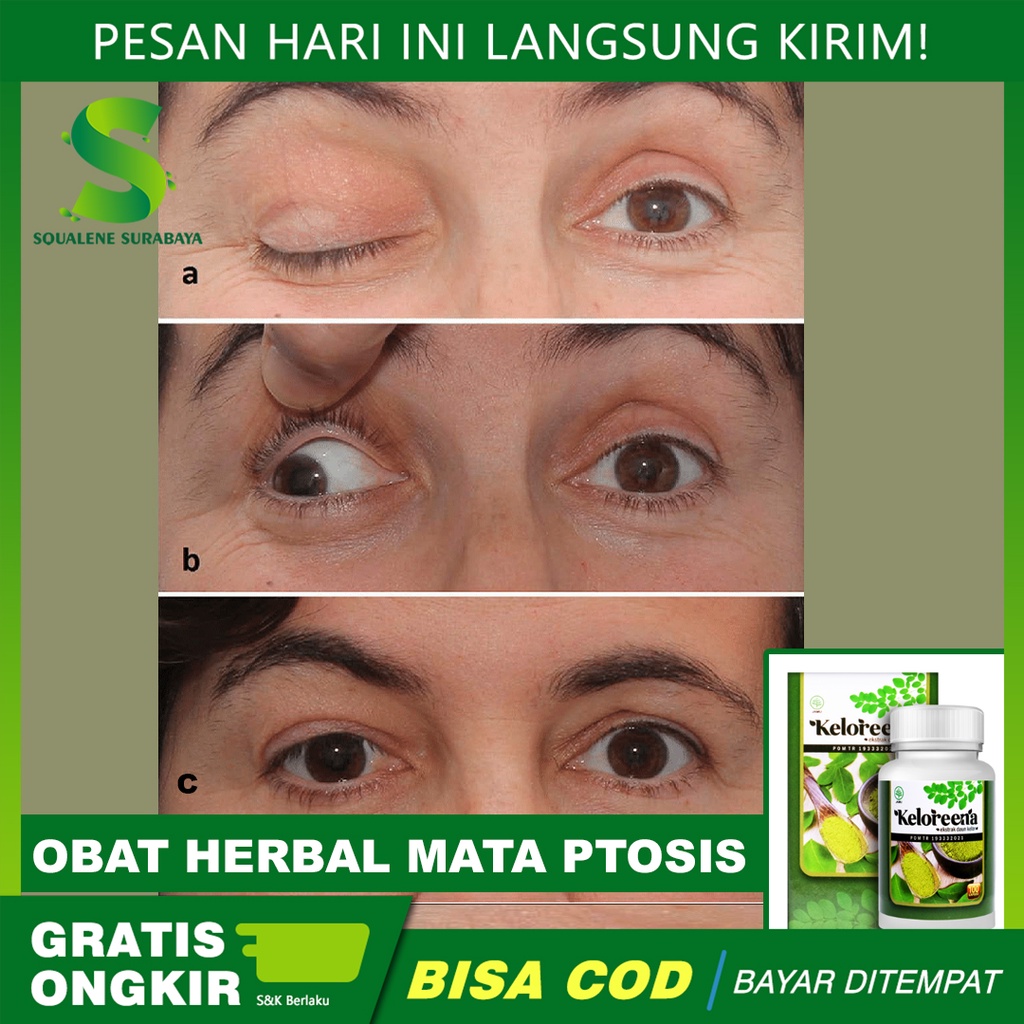 Jual Obat Mata Ptosis - Mata Kecil Sebelah - Mata Sipit Sebelah ...