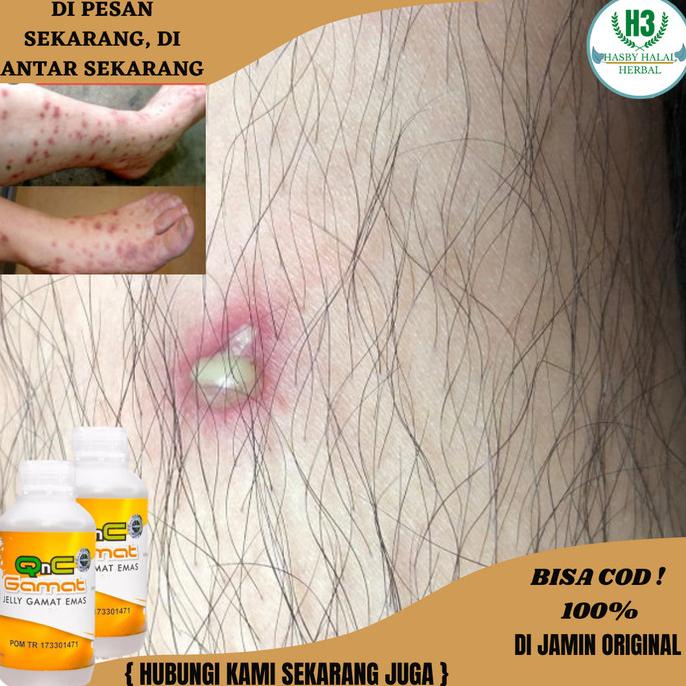 Jual Obat Untuk Koreng Bernanah, Obat Korengan Menahun, Koreng Bernanah ...