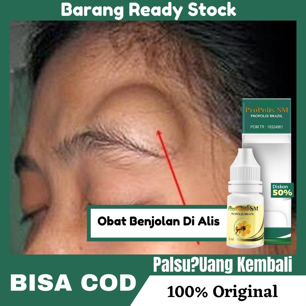 Jual Obat Benjolan Di Alis , Benjolan Di Dekat Mata , Kista Ganglion ...