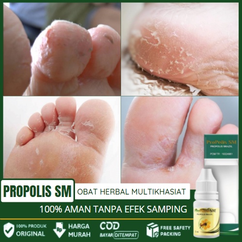 Jual Obat Kaki Mengelupas Dan Gatal - Kulit Telapak Kaki Jari Kaki Kuku ...
