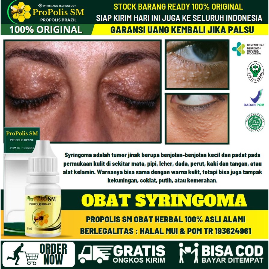 Jual Obat Penyakit Syringoma Herbal, Obat Benjolan Kecil Tumor Jinak di ...