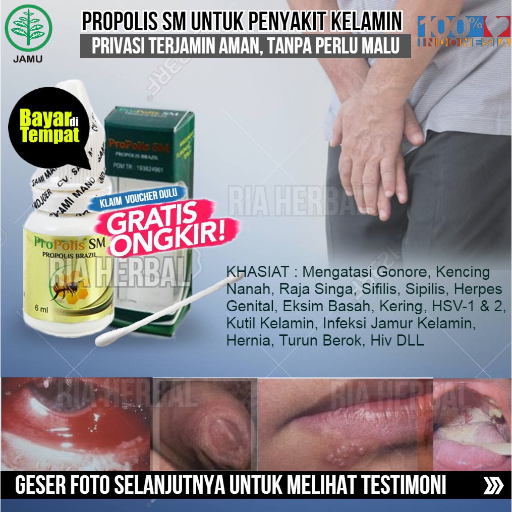 Jual Obat Gatal Raja Singa Gejala Awal Raja Singa Mencegah Mengatasi