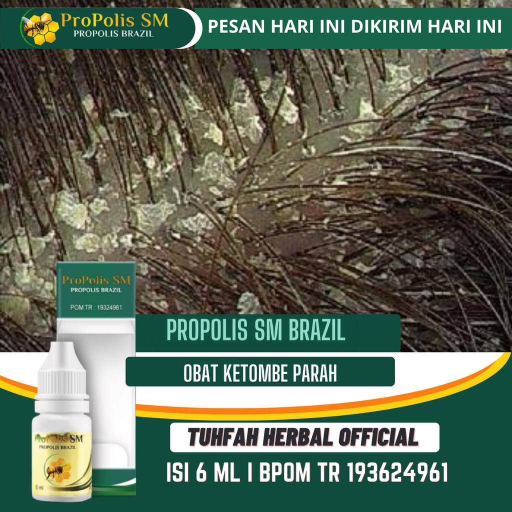 Jual Obat Ketombe, Ketombe Parah, Ketombe Rambut, Kulit Kepala Berkerak, Jamur Kulit Kepala ...
