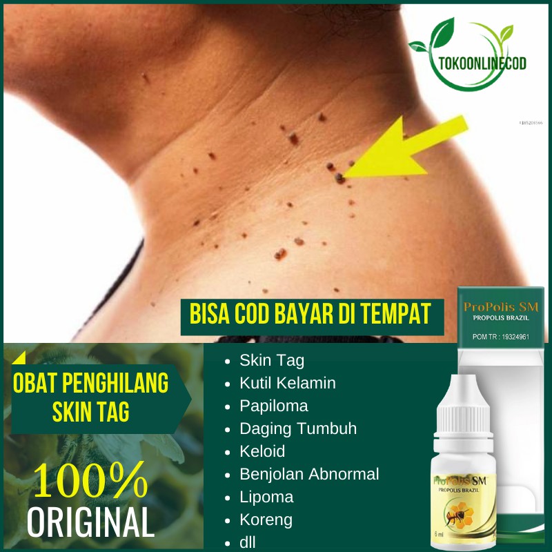 Jual Obat Skin Tag - Daging Jadi / Daging Tumbuh - Skin Tag Remover ...