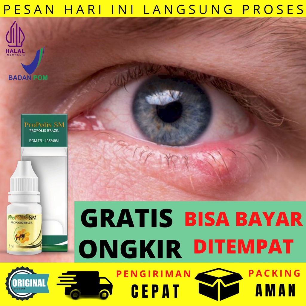 Jual Obat Mata Bintitan - Timbilan Hordeolum Di Dalam Blefaritis Alami ...
