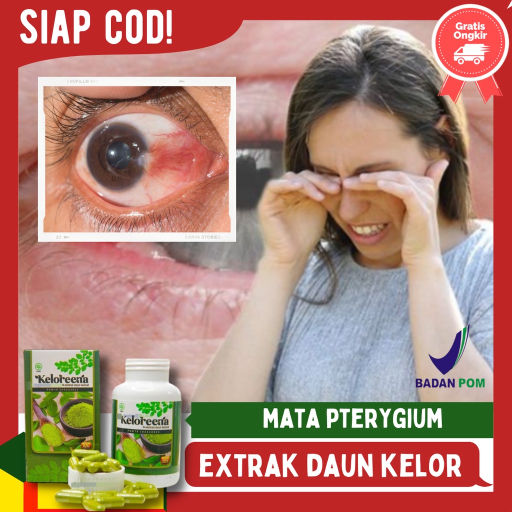 Jual Cara mengatasi pterygium pada mata sebelah kiri/Kanan | Suplemen Mata, Obat Mata Ptergium ...