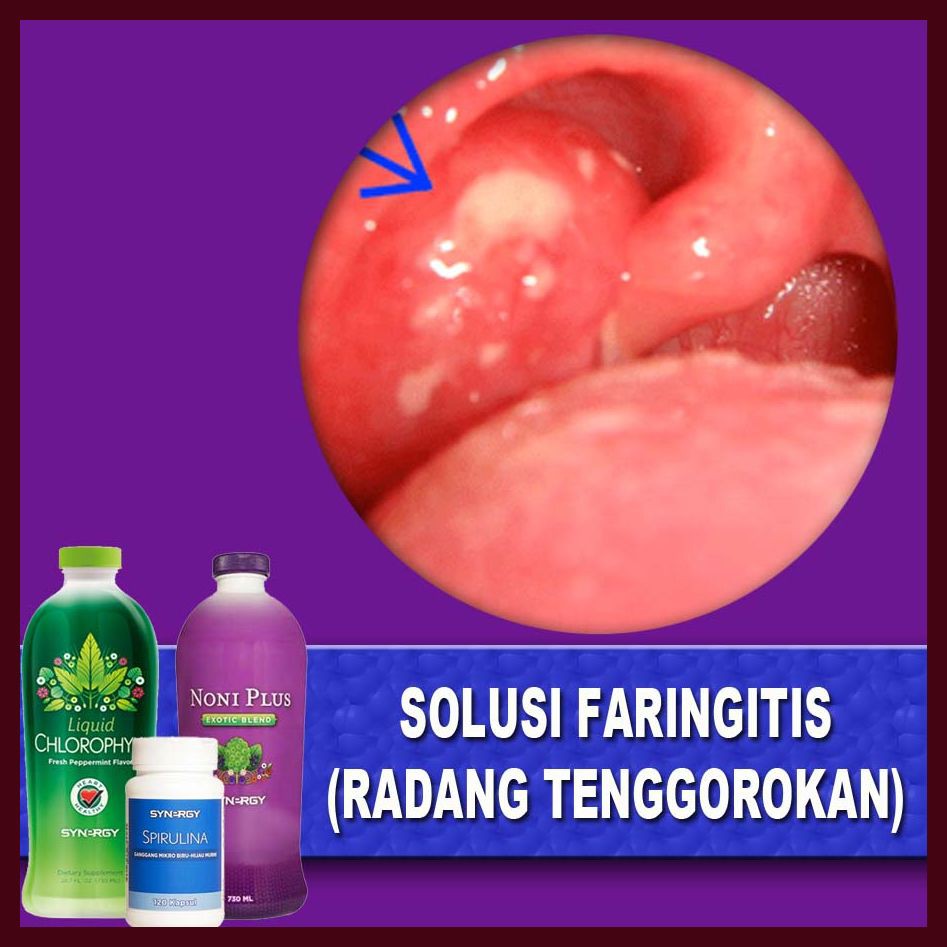 Jual Solusi Obat Radang Tenggorokan Faringitis Dan Gejala Selera Makan ...