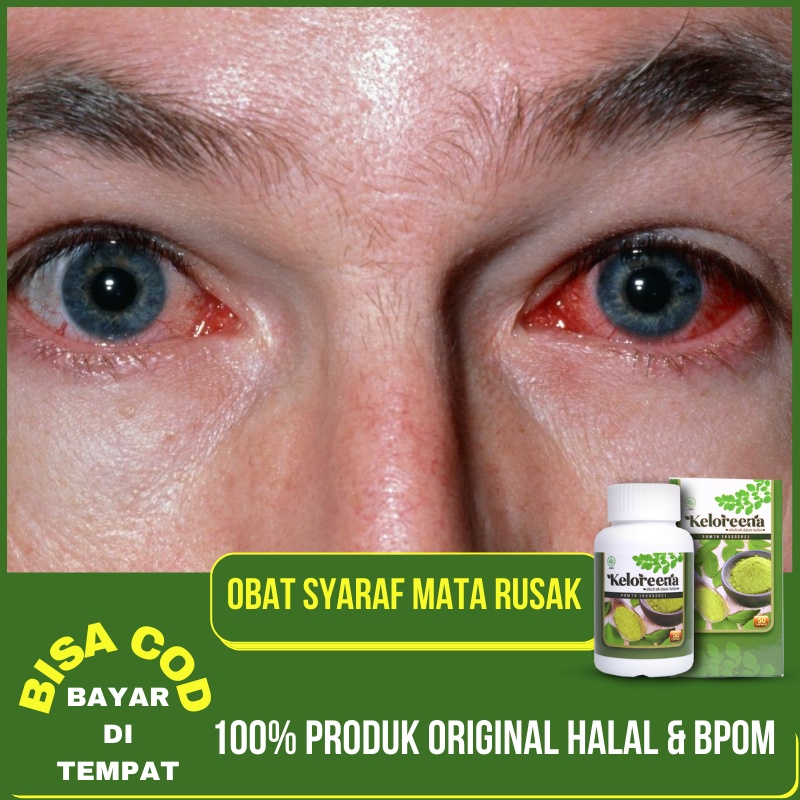 Jual Obat Syaraf Mata Rusak, Saraf Mata Putus, Mata Minus, Pandangan ...