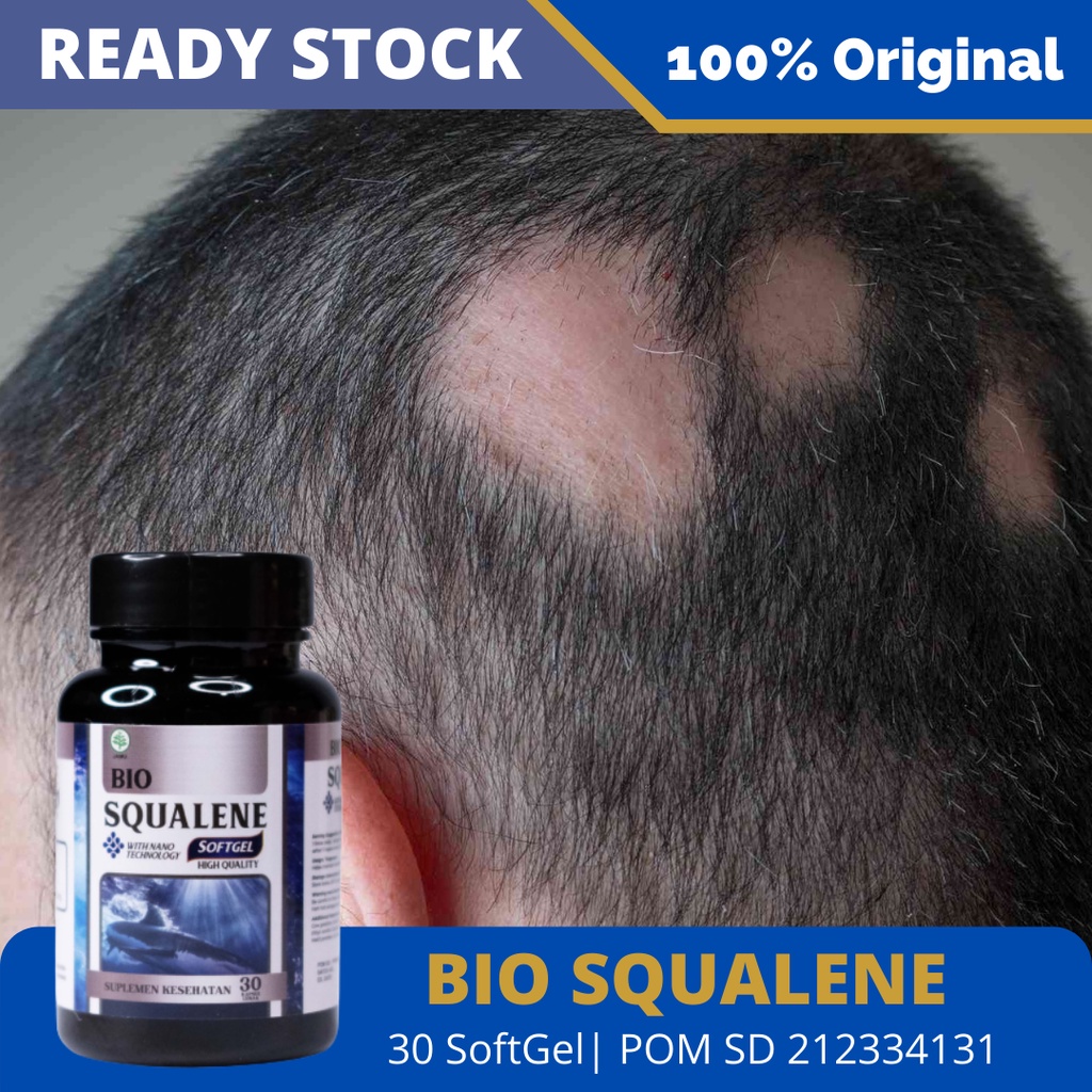 Jual Obat Alopecia Areata, Kebotakan Rambut Pada kepala, Penyakit ...