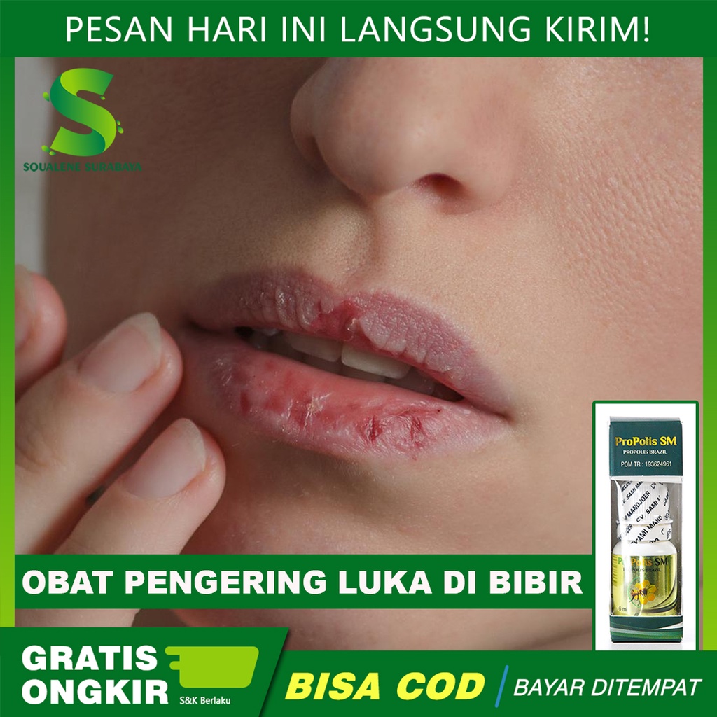 Jual Obat Pengering Luka Di Bibir - Bibir Kering - Bibir Sakit Pecah ...