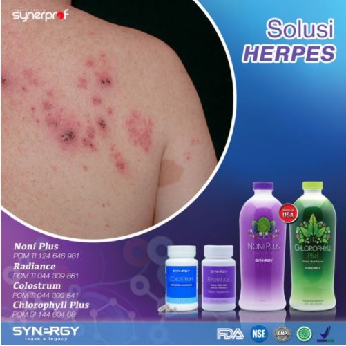 Jual Obat Solusi Herpes Produk Produk Original Synergy Usa Noni Plus ...