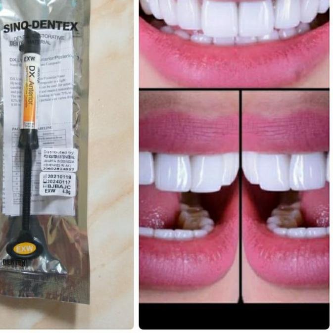 Jual SALE Composite Dentex Anterior XW dan Esthetica EXW Use Veneer Gigi 4gram|SQ3 | Shopee ...