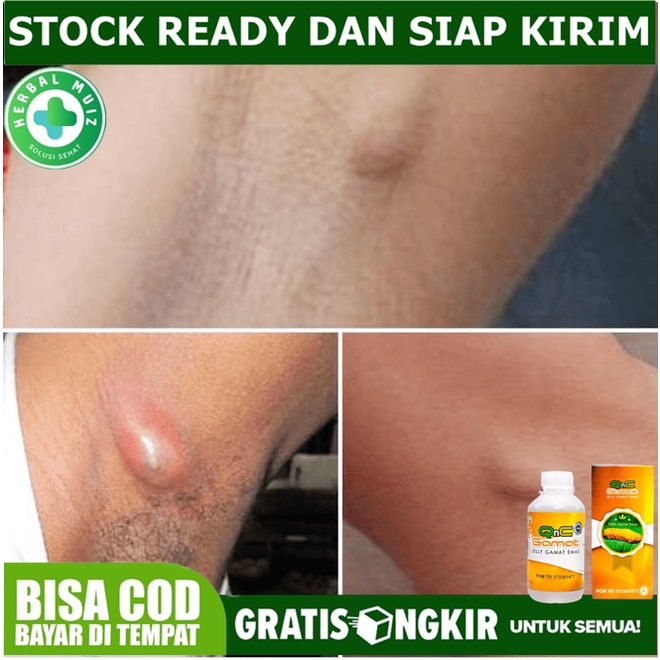 Jual Obat Herbal Benjolan Di Leher, Kepala, Ketiak, kaki, Tangan, dll ...
