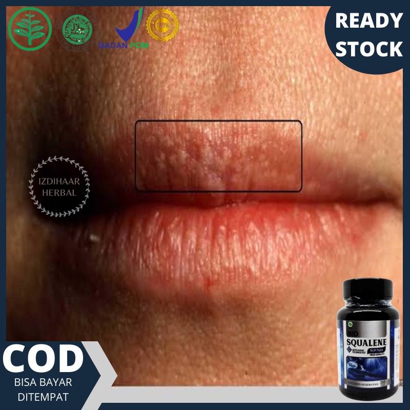 Jual Obat Bintik Putih Di Bibir, Obat Herbal Bintik-Bintik Putih Di ...