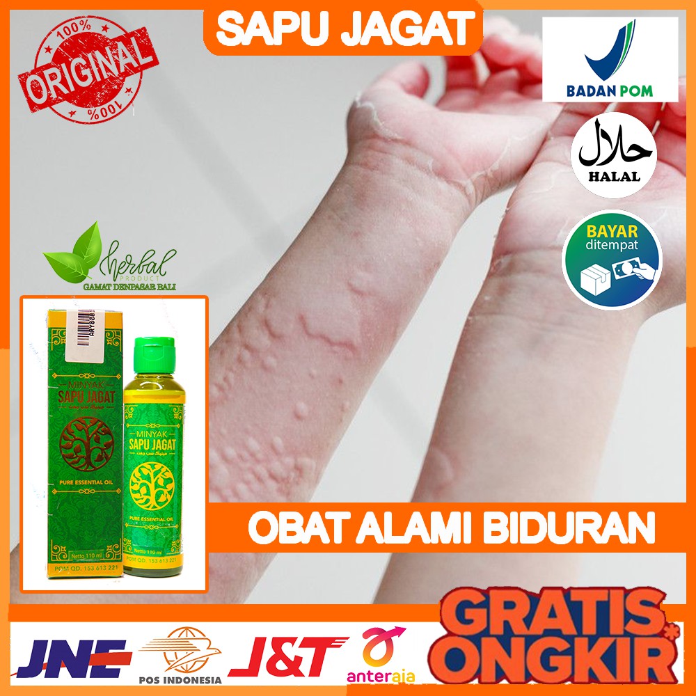 Jual Obat Biduran, Penyakit Kulit, Eksim, Ruam Merah, Alergi, Kulit ...