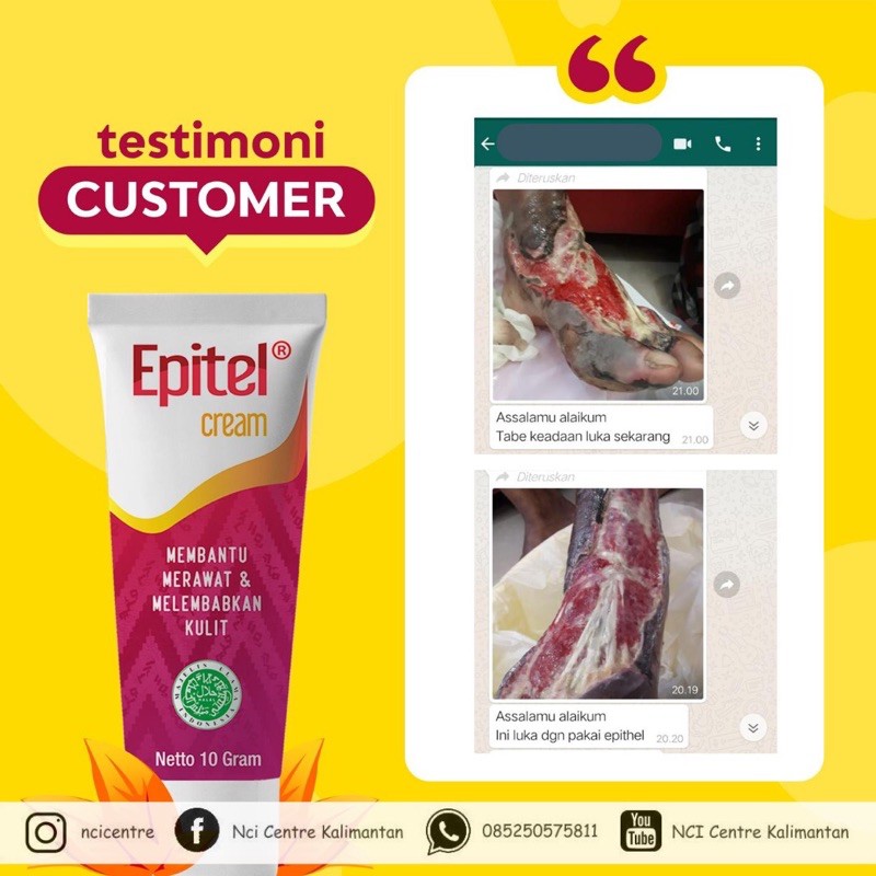 Jual epitel cream 10gr | Shopee Indonesia