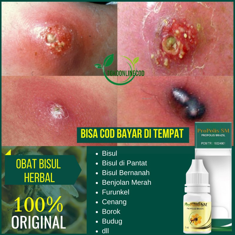 Jual Obat Bisul - Bisul di Pantat - Bisul di Anus - Furunkel - Udun ...