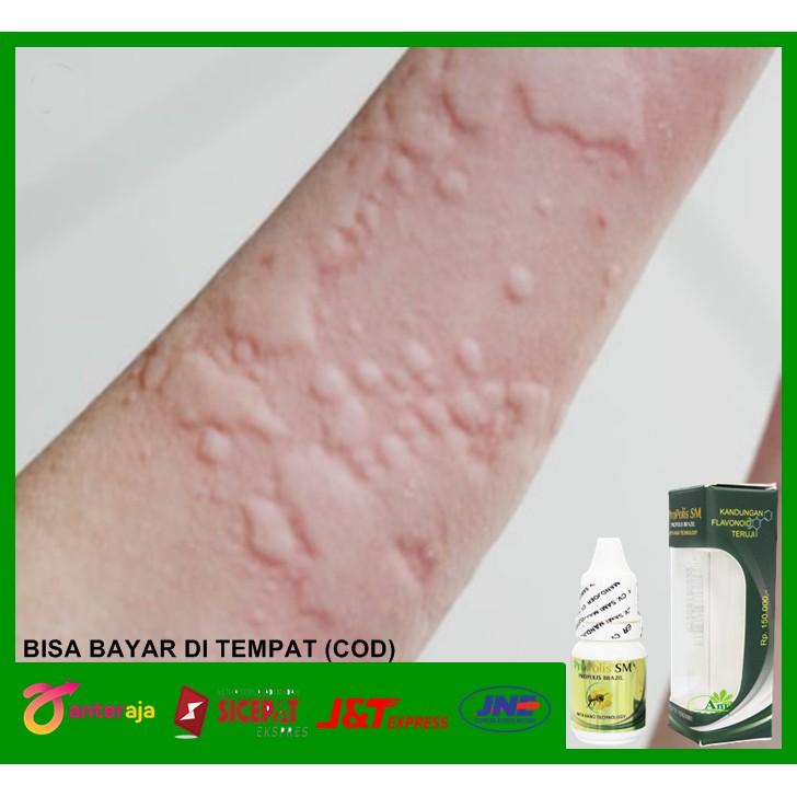 Jual Obat Alergi Dingin, Biduran, Kaligata, Gatal Gatal, Flu, Bersin ...